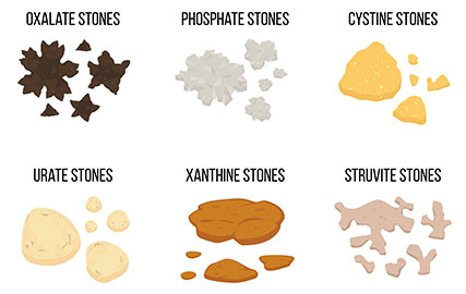 All You Need To Know About Kidney Stones | mfine