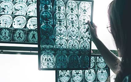 All You Need To Know About Functional Neurological Disorder