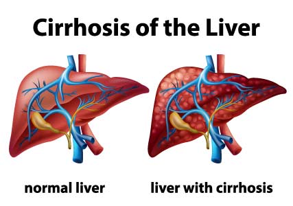 What is Non-Alcoholic Fatty Liver Disease? | Mfine