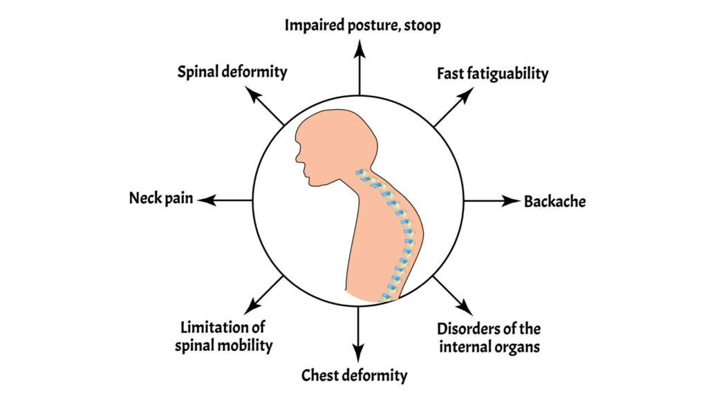 Types of Posture & Postural Deformities | Expert Guide