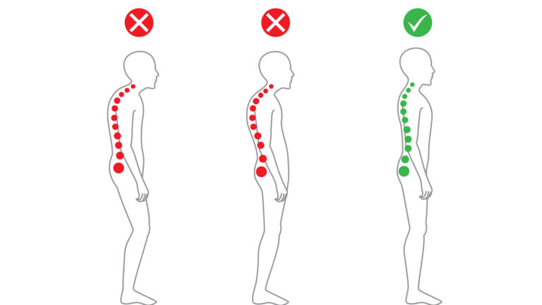Types of Posture & Postural Deformities | Expert Guide