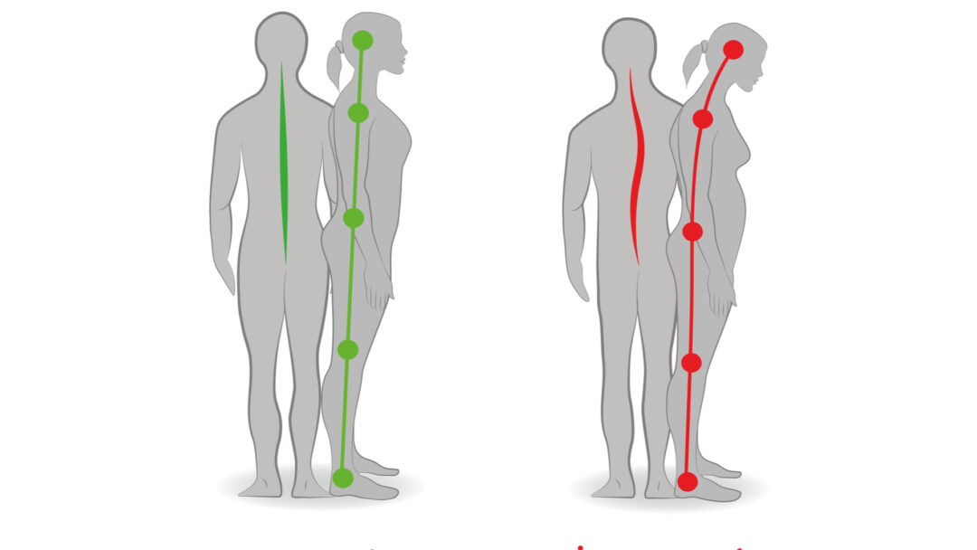 Types of Posture & Postural Deformities | Expert Guide