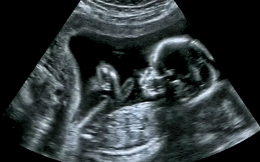 What Is A Level 2 Ultrasound MFine What Is A Level 2 Ultrasound MFine