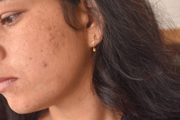 10 Types of Skin Problems in Indian Women | MFine