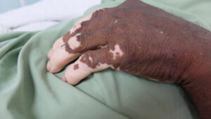 The Complete Guide on Pigmentation in Indian skin