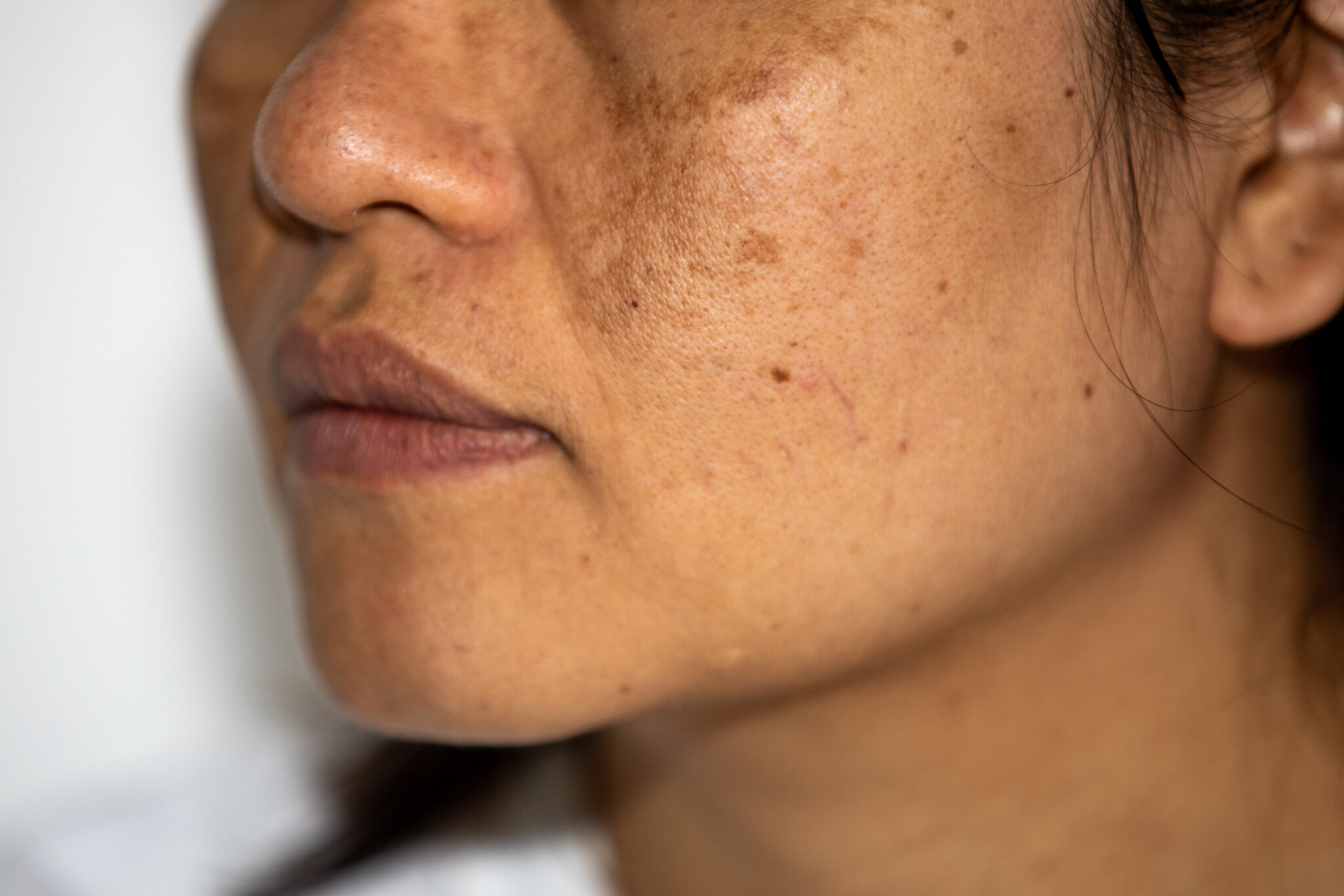 The Complete Guide on Pigmentation in Indian skin