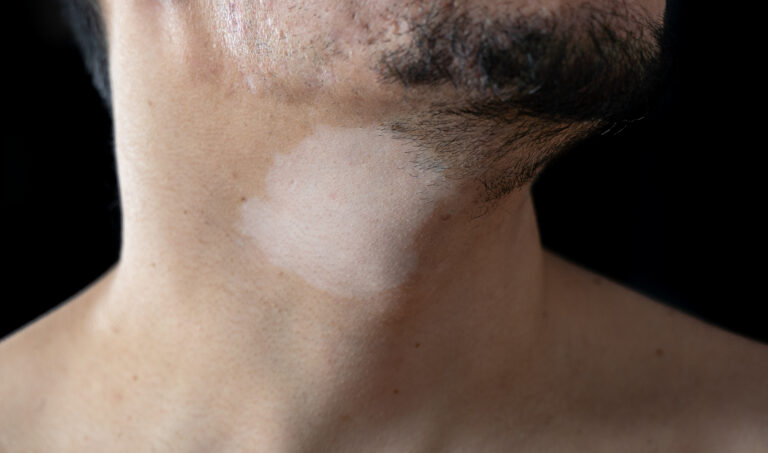 The Complete Guide on Pigmentation in Indian skin