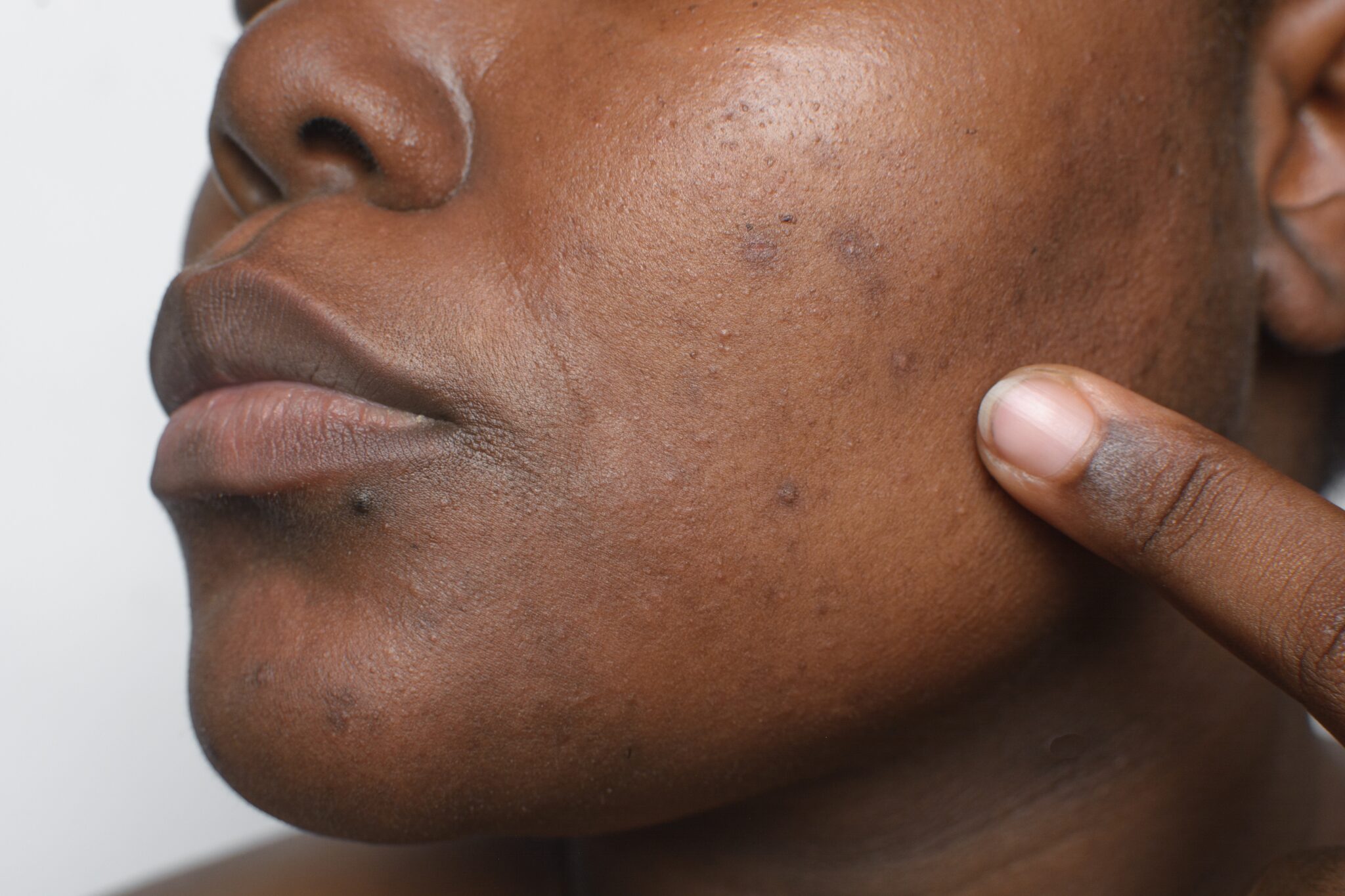 The Complete Guide on Pigmentation in Indian skin
