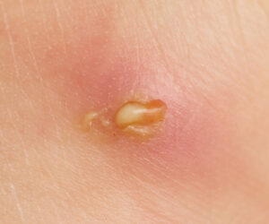 How to treat Boils (Baltod)? Expert Dermatologist Advice | MFine