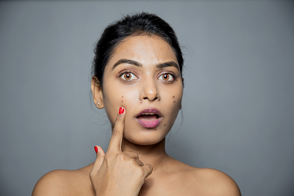 Over-the-Counter vs. Prescription Acne Treatments | MFine